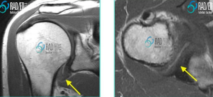 Frozen shoulder, adhesive capsulitis 진단 관련 내용 : 정상 어깨의 range of motion ...