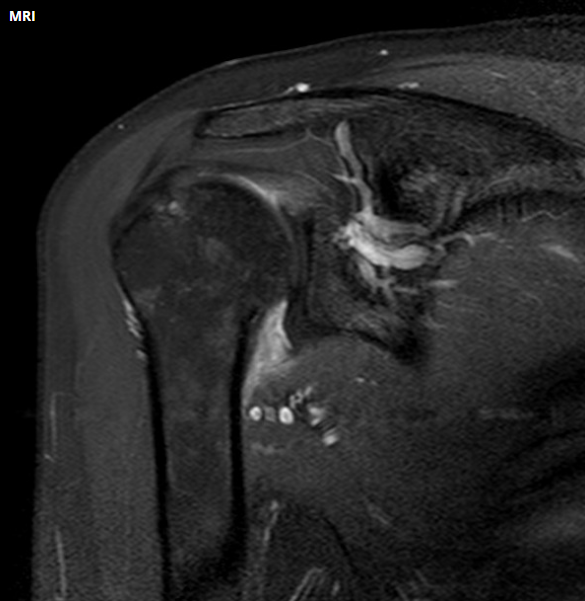 Frozen shoulder, adhesive capsulitis 진단 관련 내용 : 정상 어깨의 range of motion ...