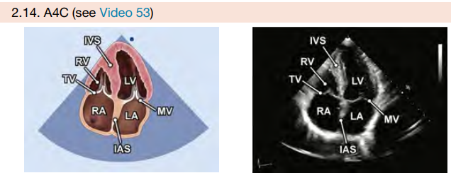 심장초음파(TTE) 2D 영상_apical, subcostal, suprasternal notch window : 네이버 블로그