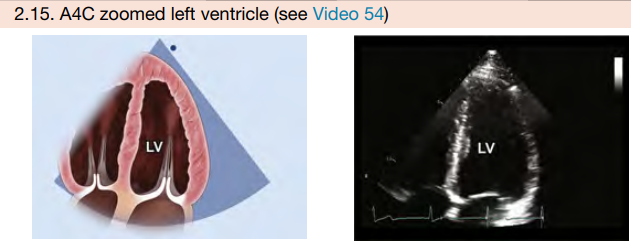 심장초음파(TTE) 2D 영상_apical, subcostal, suprasternal notch window : 네이버 블로그