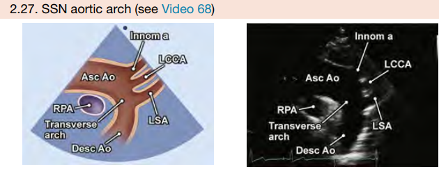 심장초음파(TTE) 2D 영상_apical, subcostal, suprasternal notch window : 네이버 블로그