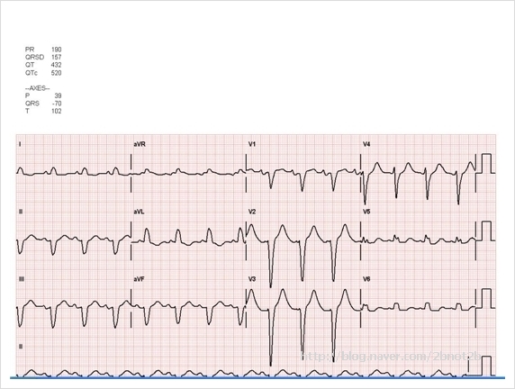 울혈성 심부전-(CHF, congestive heart failure) : 네이버 블로그