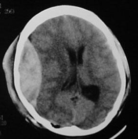 경막외출혈 (경막상출혈, epidural hemorrhage) : 네이버 블로그