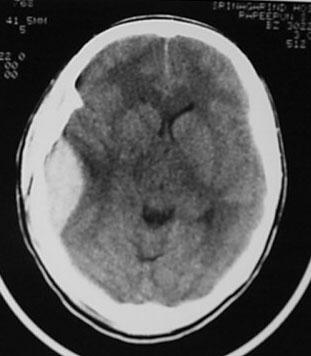 경막외출혈 (경막상출혈, epidural hemorrhage) : 네이버 블로그