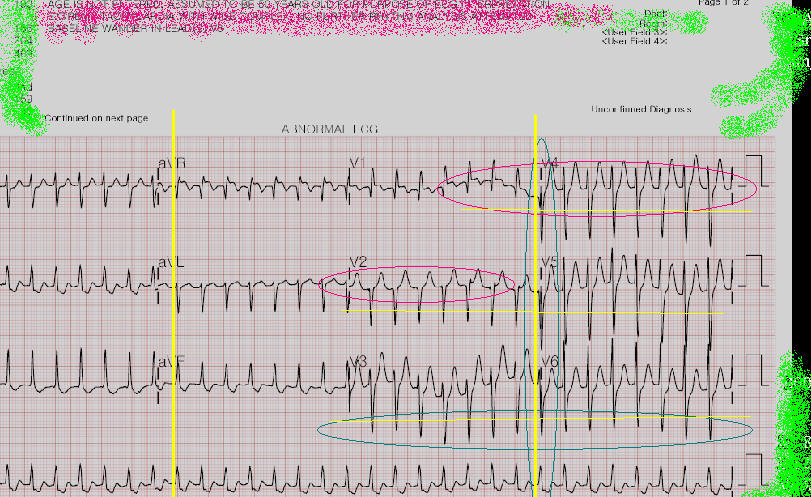[PSVT의 EKG챠트 분석] : 네이버 블로그