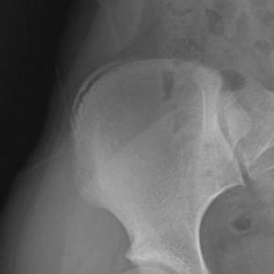 성장판(골반); Risser sign : 네이버 블로그