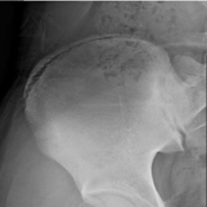 성장판(골반); Risser sign : 네이버 블로그