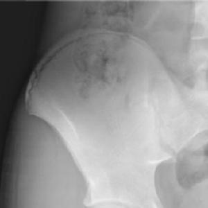 성장판(골반); Risser sign : 네이버 블로그